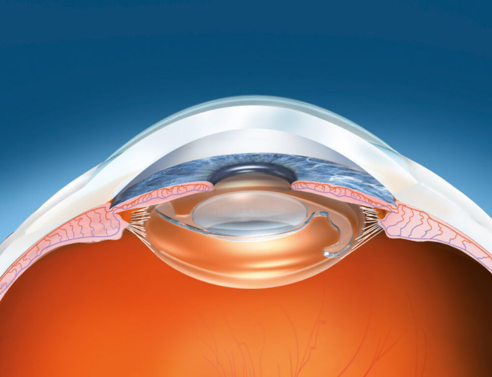 Cirurgia de Catarata: opacificação da cápsula posterior - NeoOftalmo