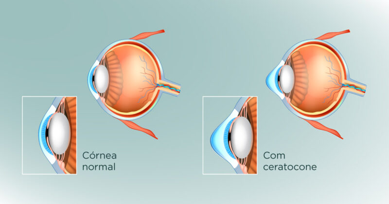 Qual a causa do Ceratocone? | NeoOftalmo